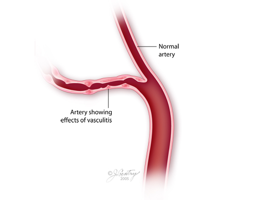 Vasculitis – NHR Association