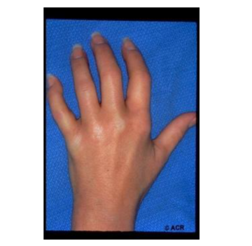 Scleroderma (Systemic Sclerosis) – NHR Association